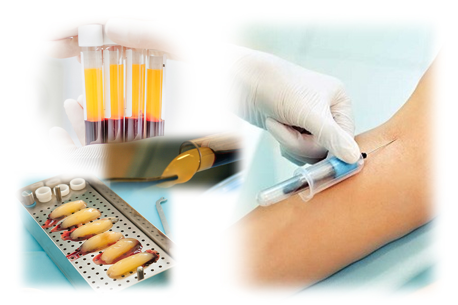 Platelet-Rich Fibrin (PRF)